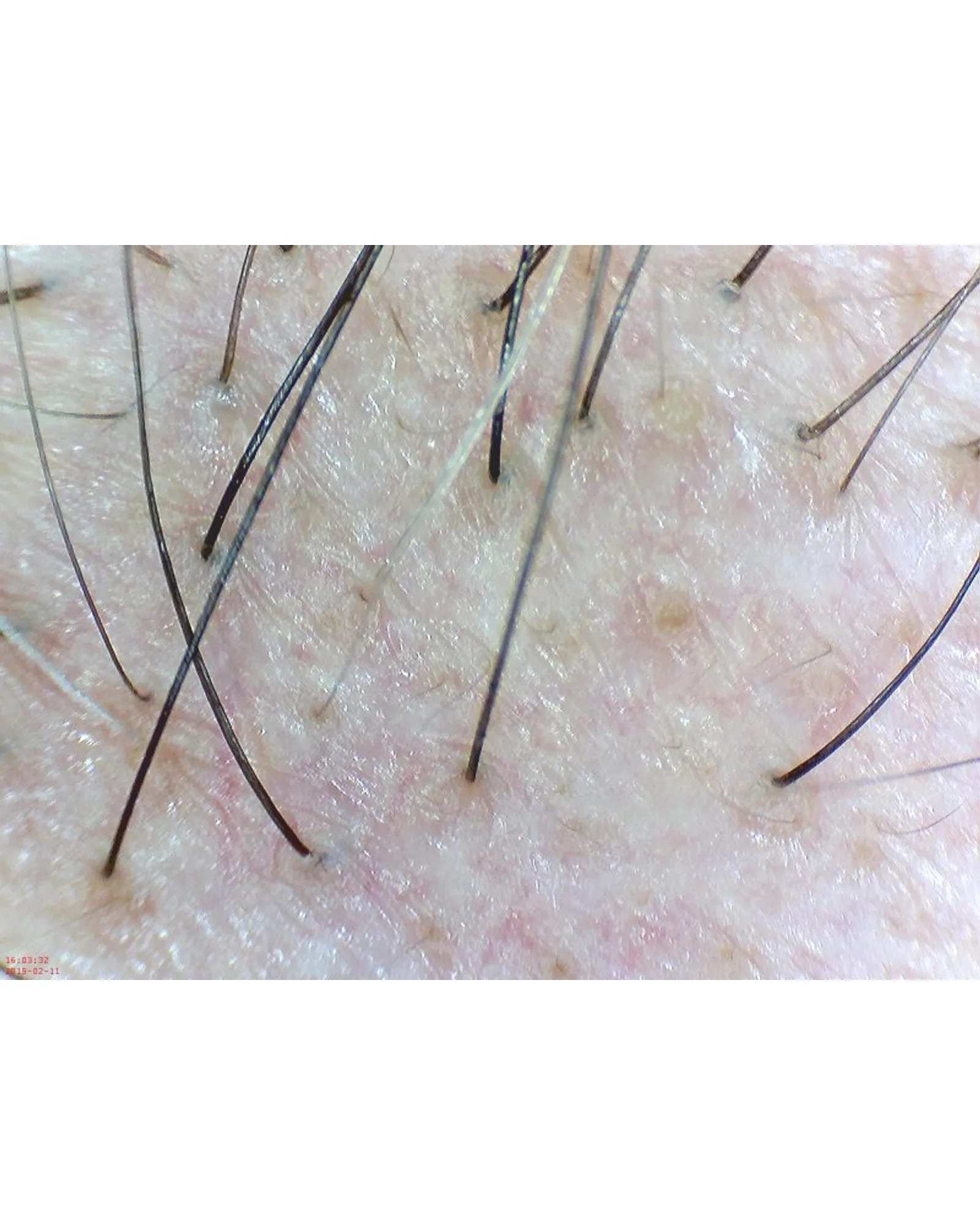 Tricoscópio Sem Fio Firefly DE 337T Diagnóstico Capilar Profissional ...