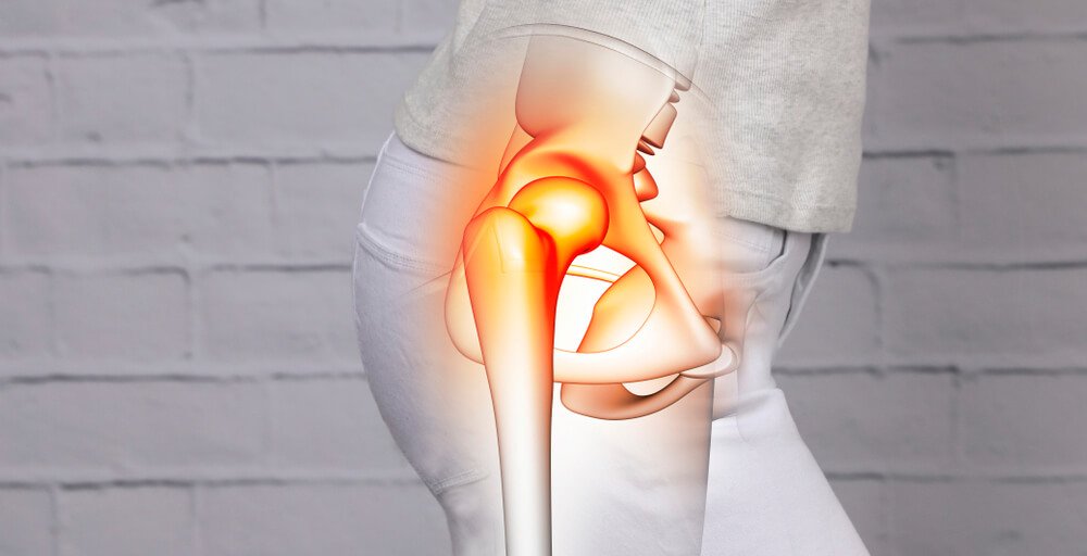 Tudo sobre a síndrome do piriforme | Reabilitech