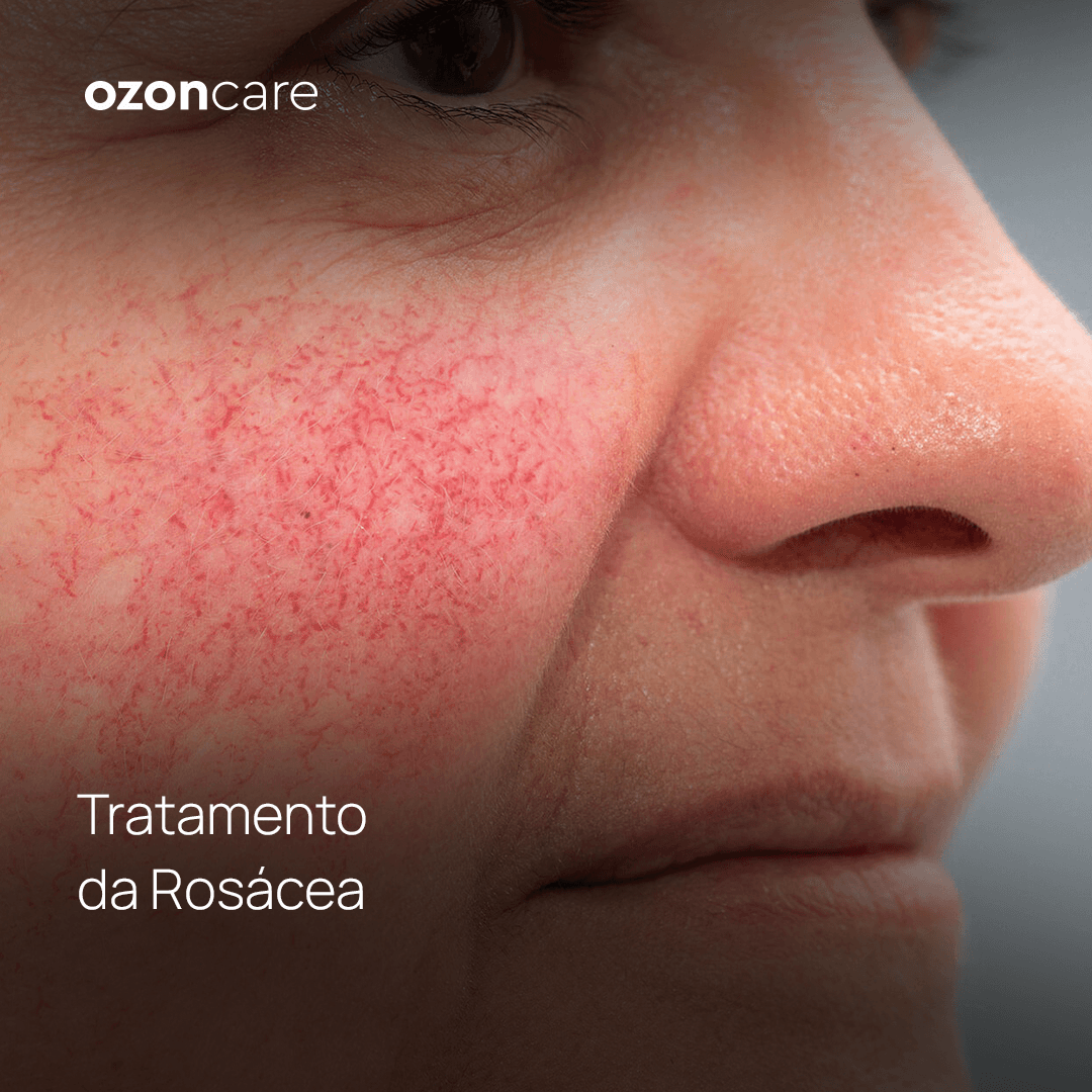 Tratamento De Rosacea Rosácea Farmácias Alfafoz