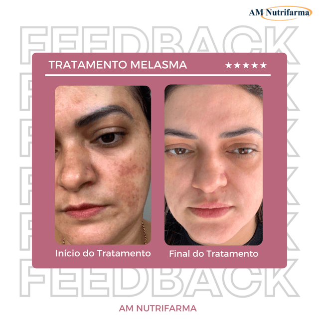 Kit Melasma Completo - 10 Produtos | Am Nutrifarma
