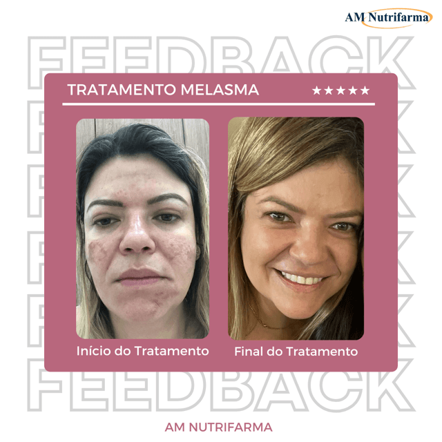 Kit Melasma - 3 Produtos | Am Nutrifarma