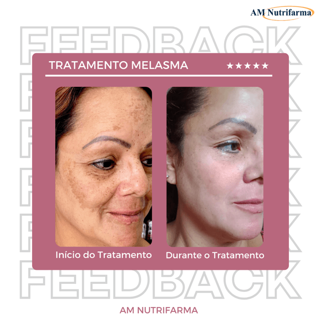 Kit Melasma - 5 Produtos | Am Nutrifarma