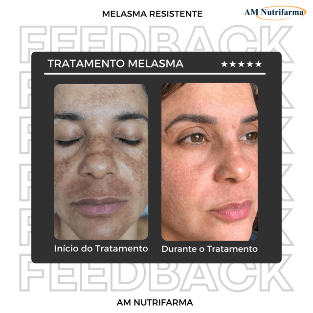Kit Melasma Resistente - 5 Produtos | Am Nutrifarma