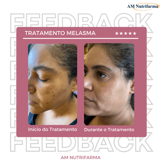Kit Melasma Peeling Oral + Probiótico Para Melasma - 30 Cápsulas | Am Nutrifarma