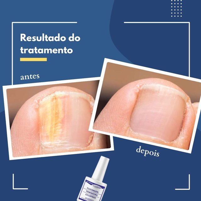 KIT 2 Bases Tratamento de Micose nas Unhas | Am Nutrifarma