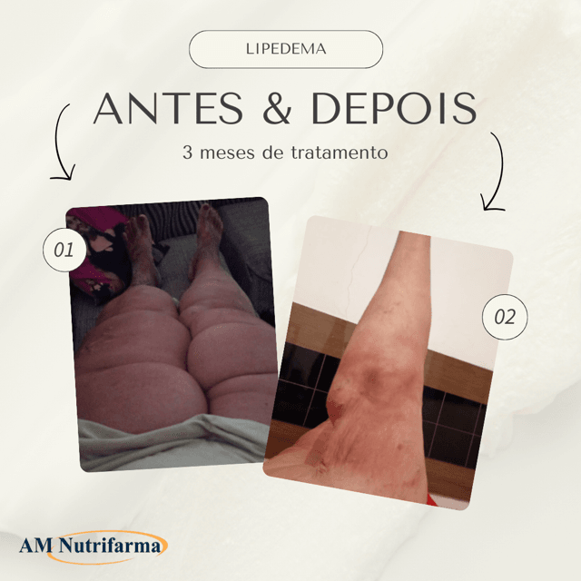 Composto para Lipedema - 30 Doses | Am Nutrifarma